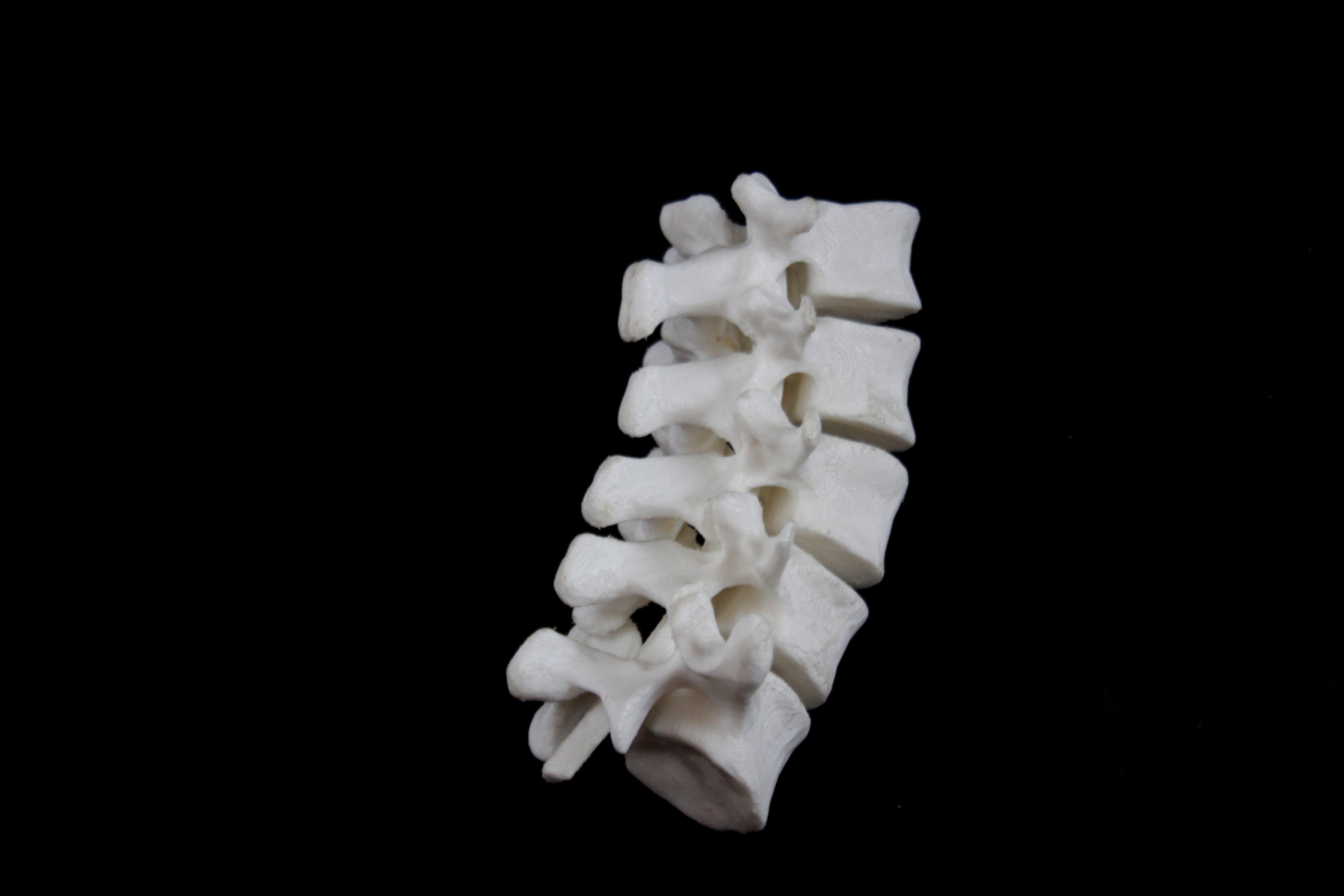 3D Printable Lumbar Vertebrae by Annalize Butler