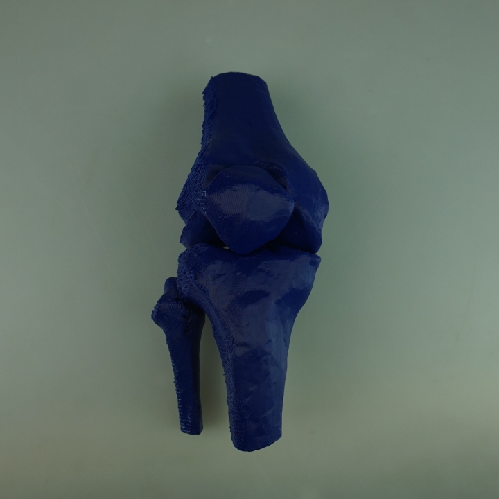 3D Printable Knee - Proximal Tibia Fracture by Bruno Gobbato