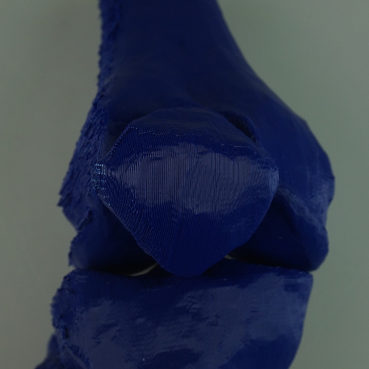 3D Printable Knee - Proximal Tibia Fracture by Bruno Gobbato