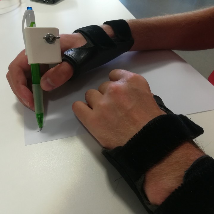 3D Printable Metacarpal splint by Matthias Van De Walle