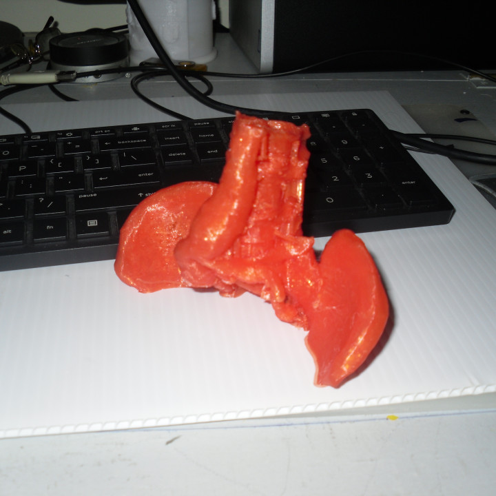 3D Printable Abdominal aortic aneurysm (AAA or triple A) by rudy liggett
